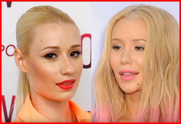 Iggy Azalea Plastic Surgery Pictures - Celebrities Plastic Surgery